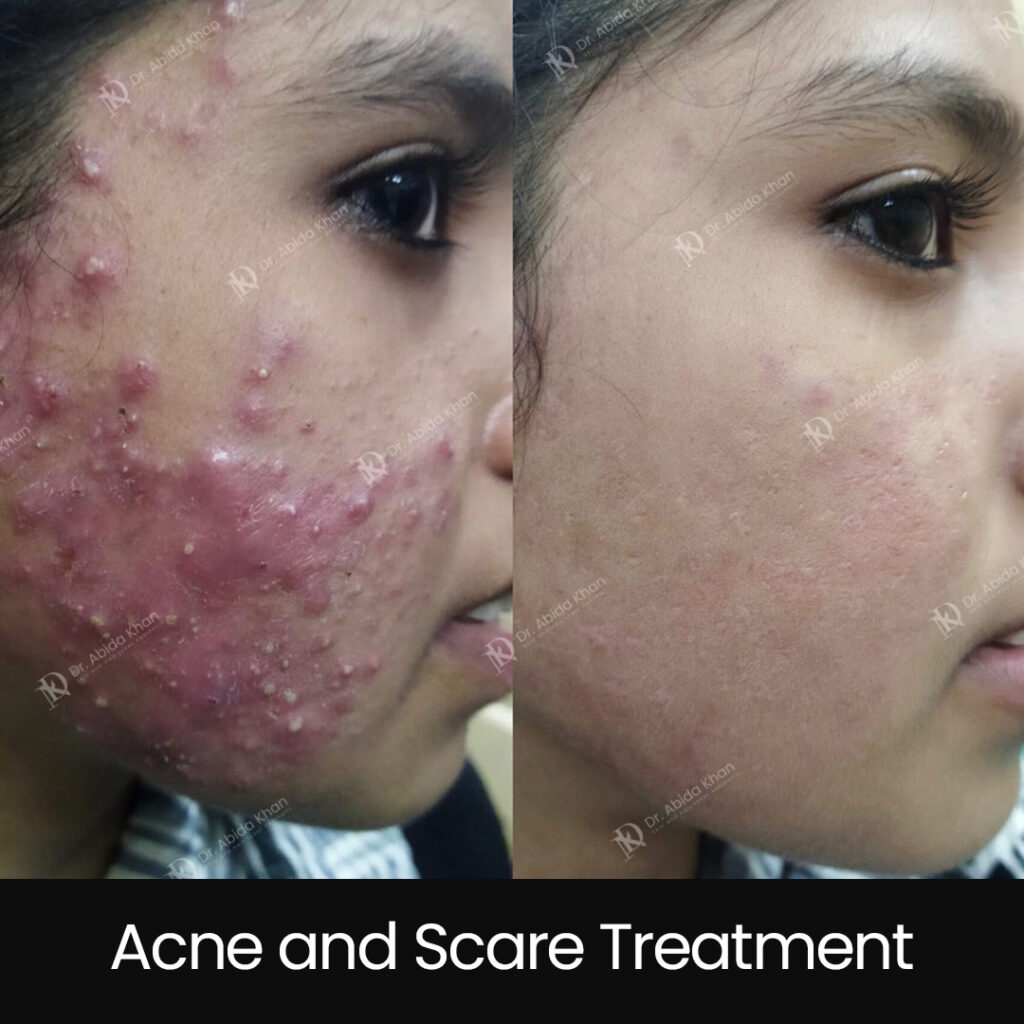 Case Studies - Dr. Abida Khan – Best Skin Specialist & Dermatologist in Mumbra | Skin Clinic ...